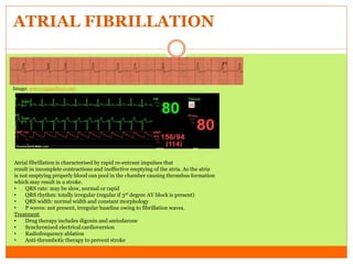 Atrial arrhythmias(2) | PPT
