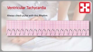 Atrial dysrhythmia | PPT