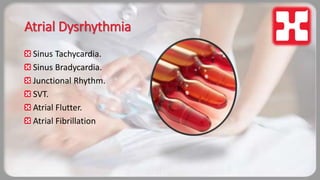 Atrial dysrhythmia | PPT