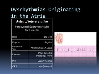 Atrial dysrhythmias | PPTX