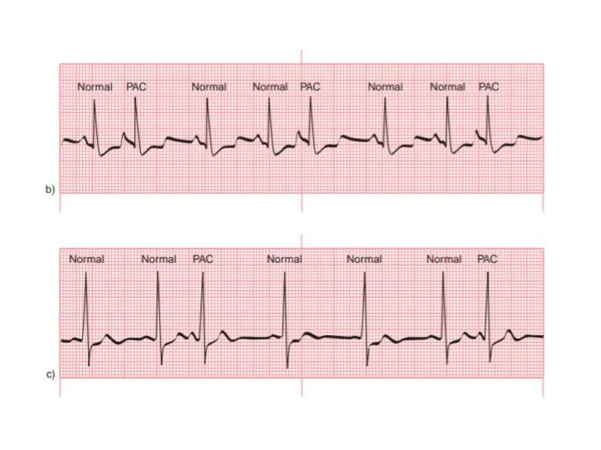 ATRIAL DYSRHYTHMIAS AND HOW TO INTERPRET IN ECG? | PPT