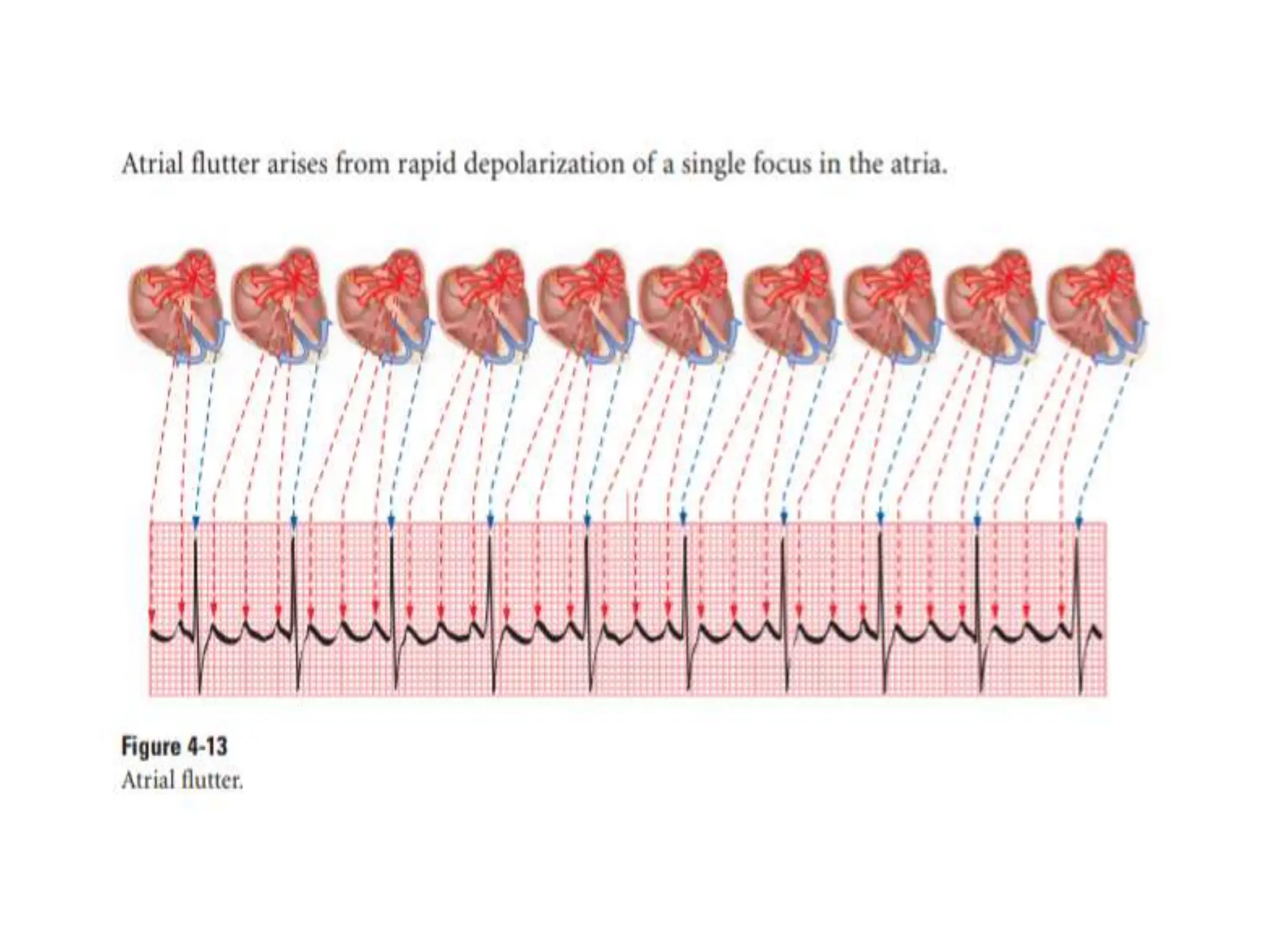 ATRIAL DYSRHYTHMIAS AND HOW TO INTERPRET IN ECG? | PPT