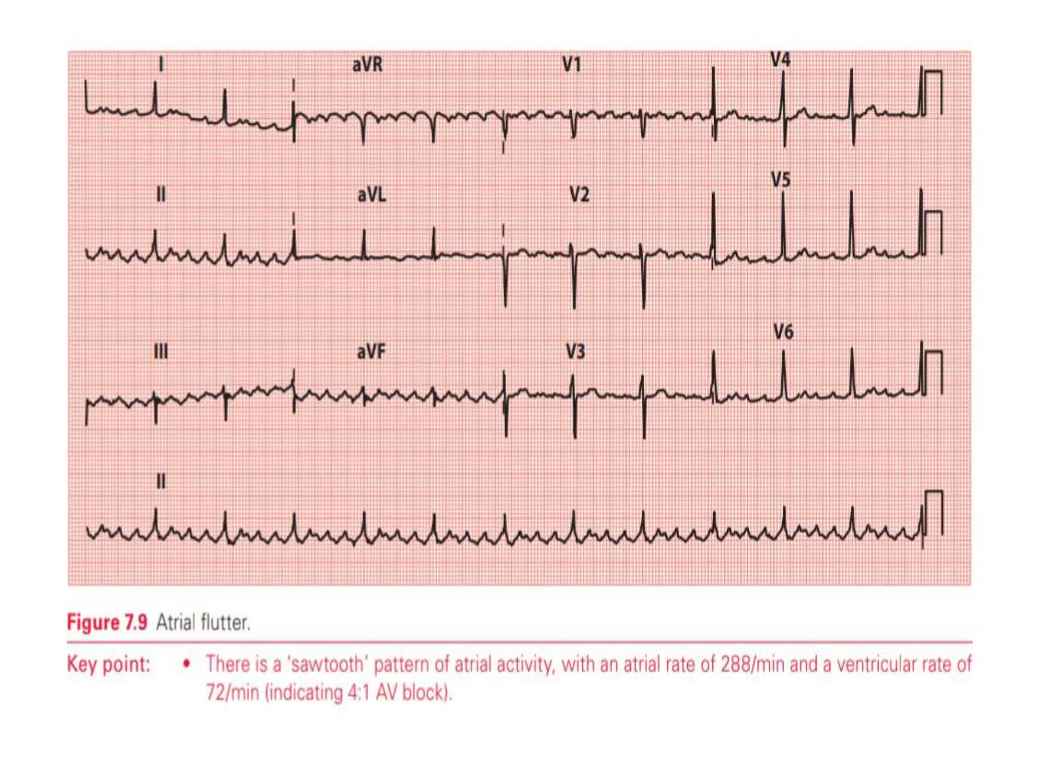 ATRIAL DYSRHYTHMIAS AND HOW TO INTERPRET IN ECG? | PPT