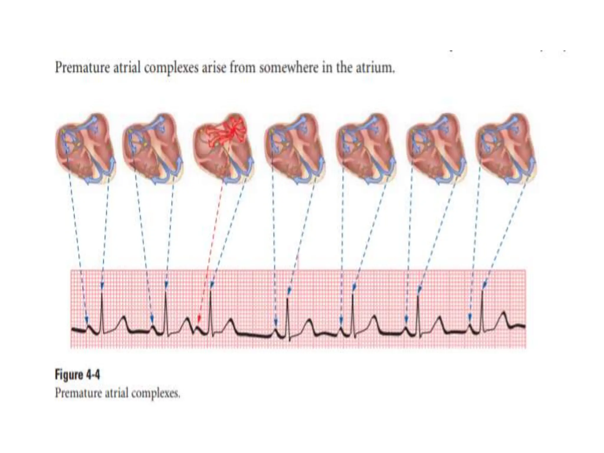 ATRIAL DYSRHYTHMIAS AND HOW TO INTERPRET IN ECG? | PPT