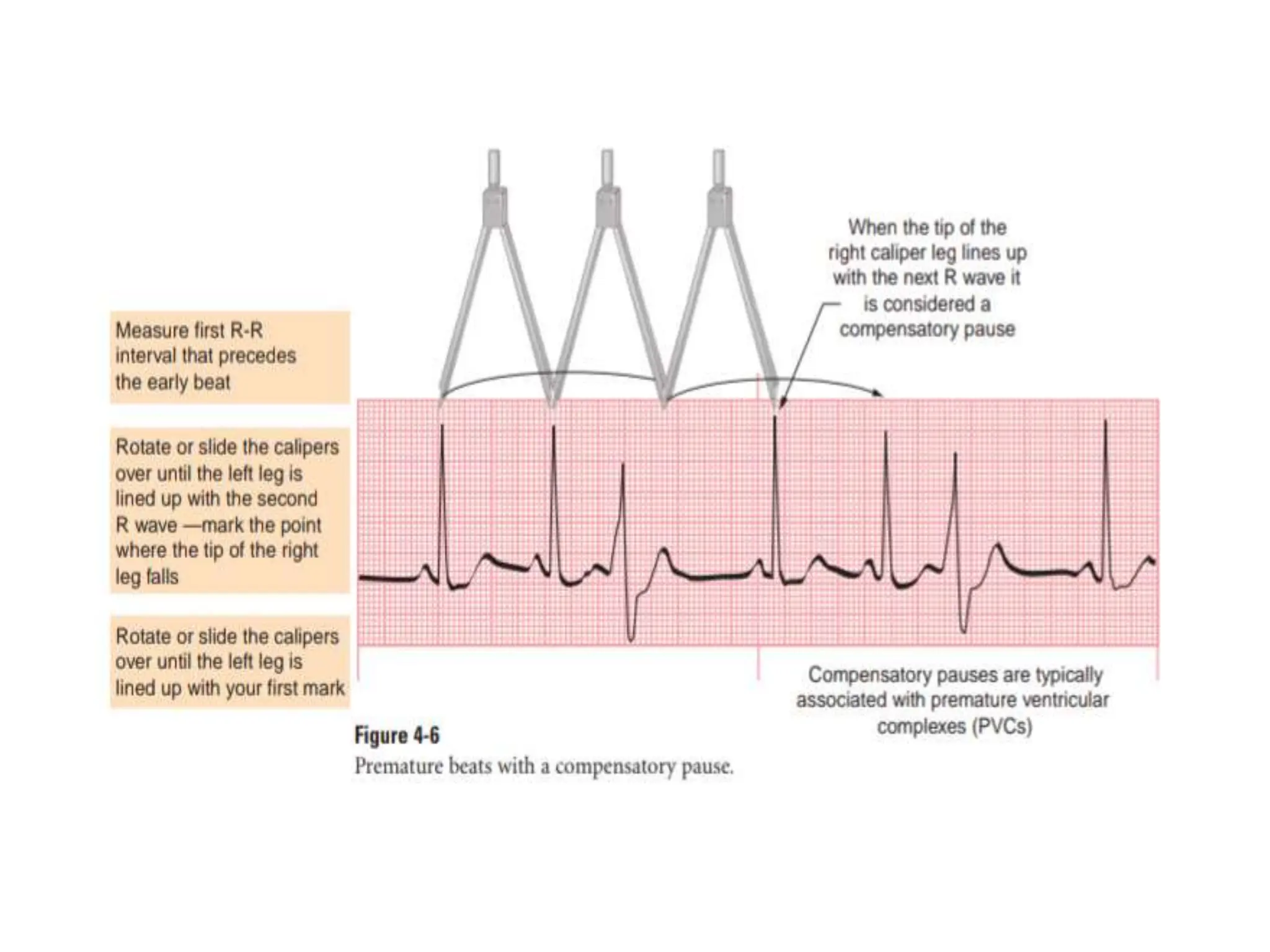 ATRIAL DYSRHYTHMIAS AND HOW TO INTERPRET IN ECG? | PPT
