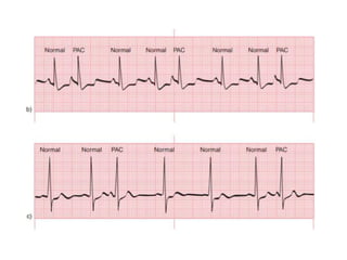 ATRIAL DYSRHYTHMIAS AND HOW TO INTERPRET IN ECG? | PPT