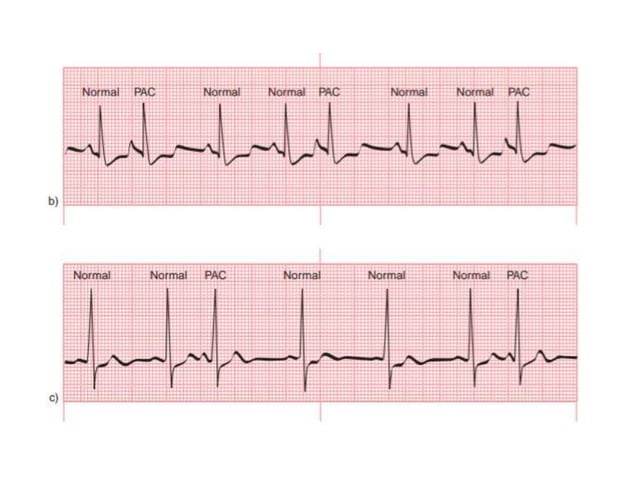 ATRIAL DYSRHYTHMIAS AND HOW TO INTERPRET IN ECG? | PPTX