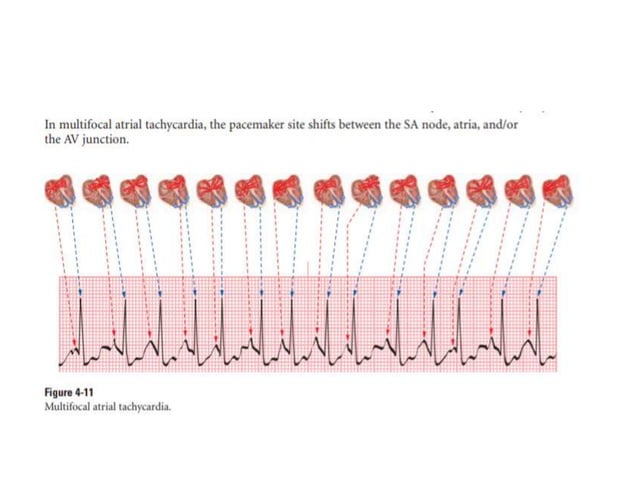 ATRIAL DYSRHYTHMIAS AND HOW TO INTERPRET IN ECG? | PPTX