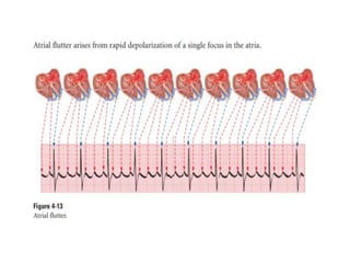 ATRIAL DYSRHYTHMIAS AND HOW TO INTERPRET IN ECG? | PPT