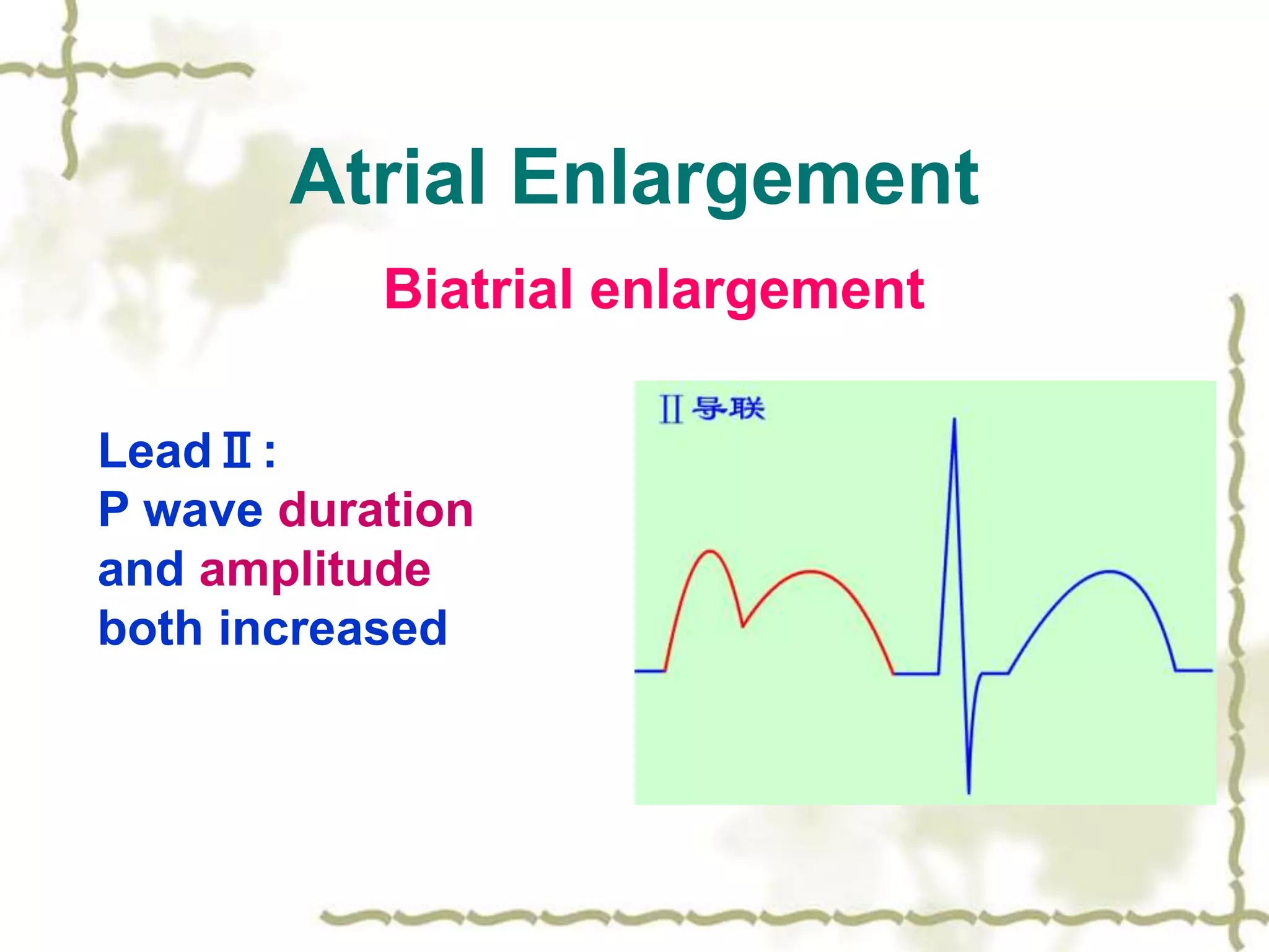 Atrial enlargement and ventricular.ppt