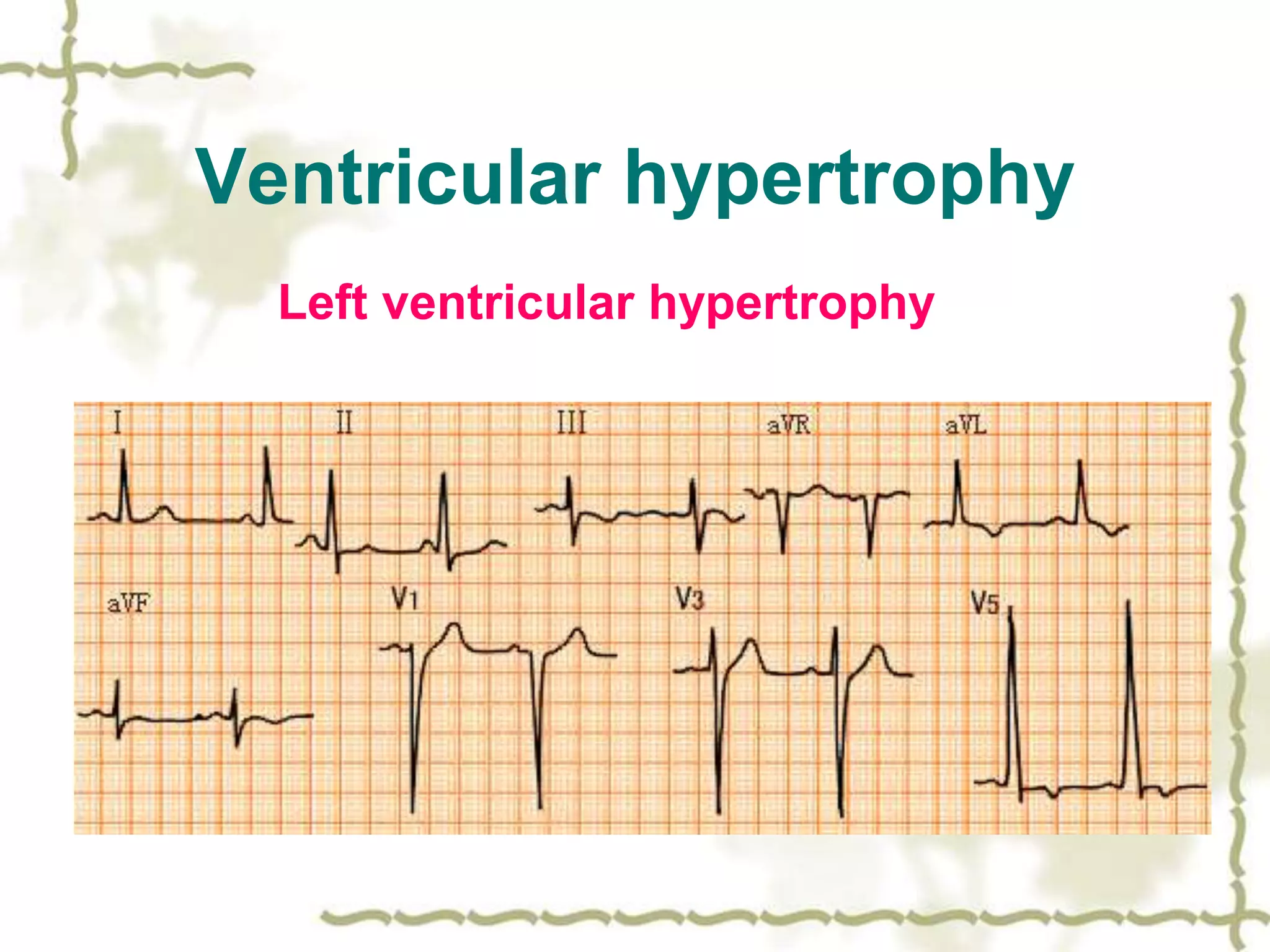 Atrial enlargement and ventricular.ppt