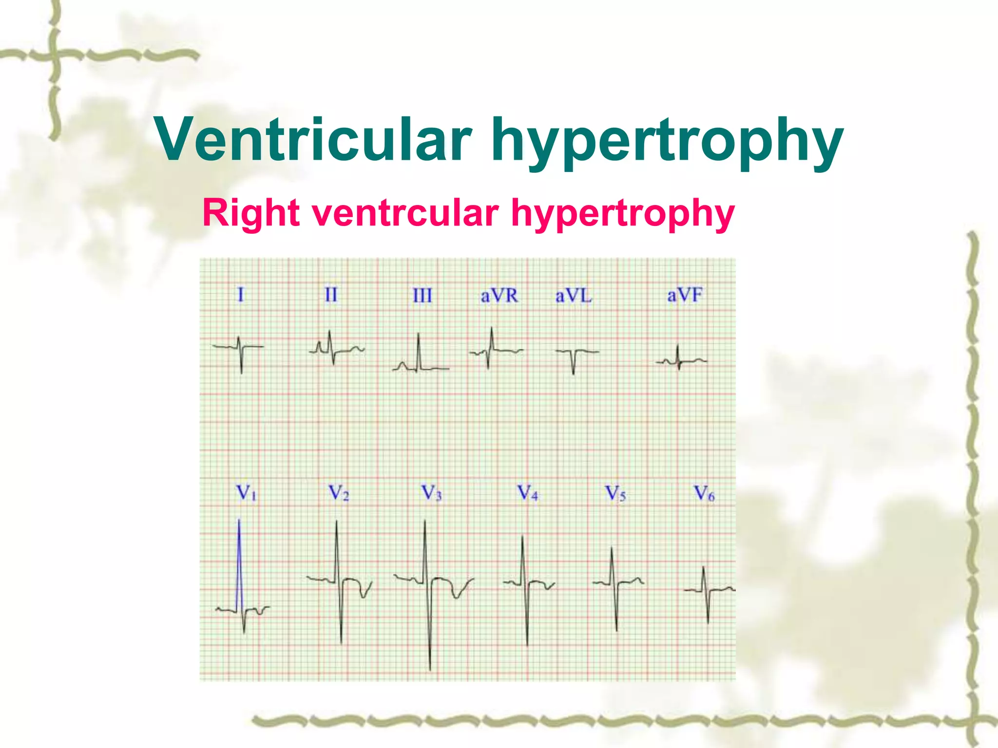 Atrial enlargement and ventricular.ppt