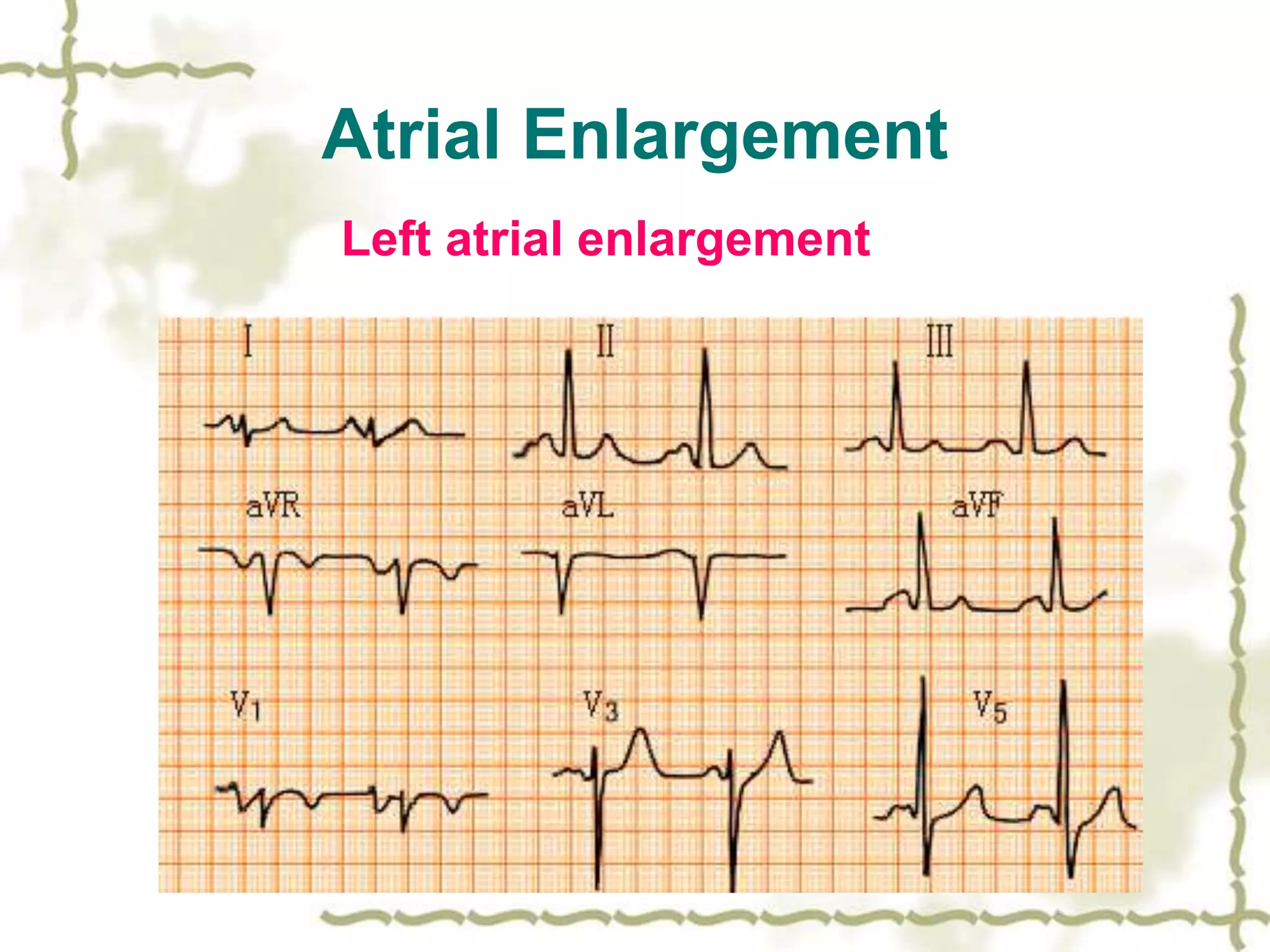 Atrial Enlargement And Ventricular Ppt Heart And Cardiovascular Diseases Diseases And Conditions