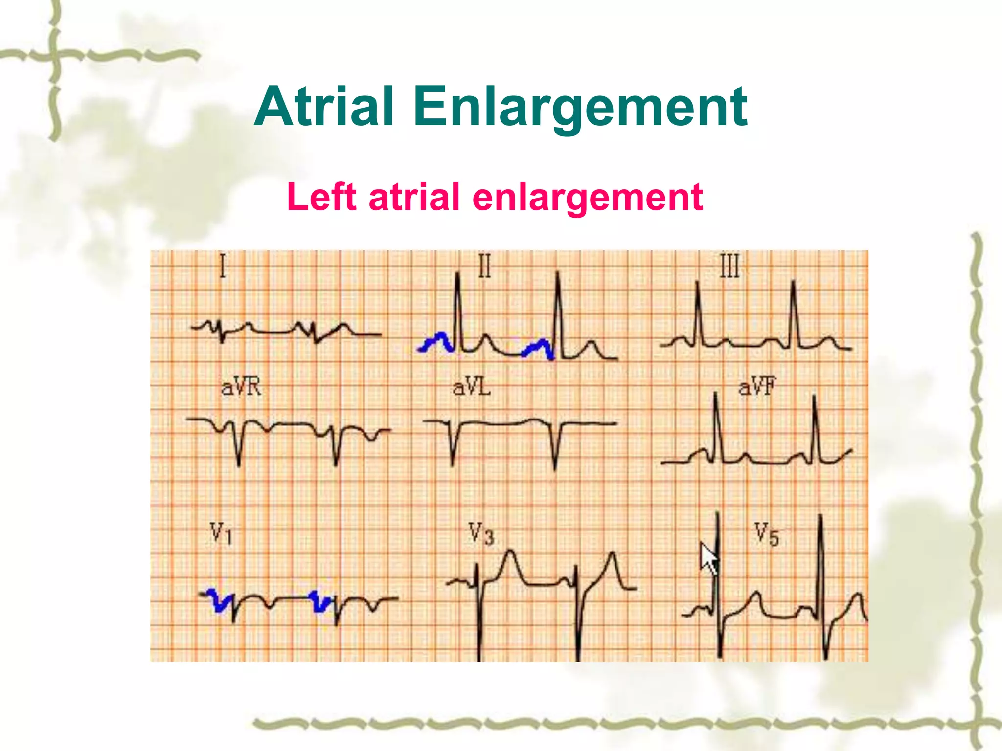 Atrial enlargement and ventricular.ppt