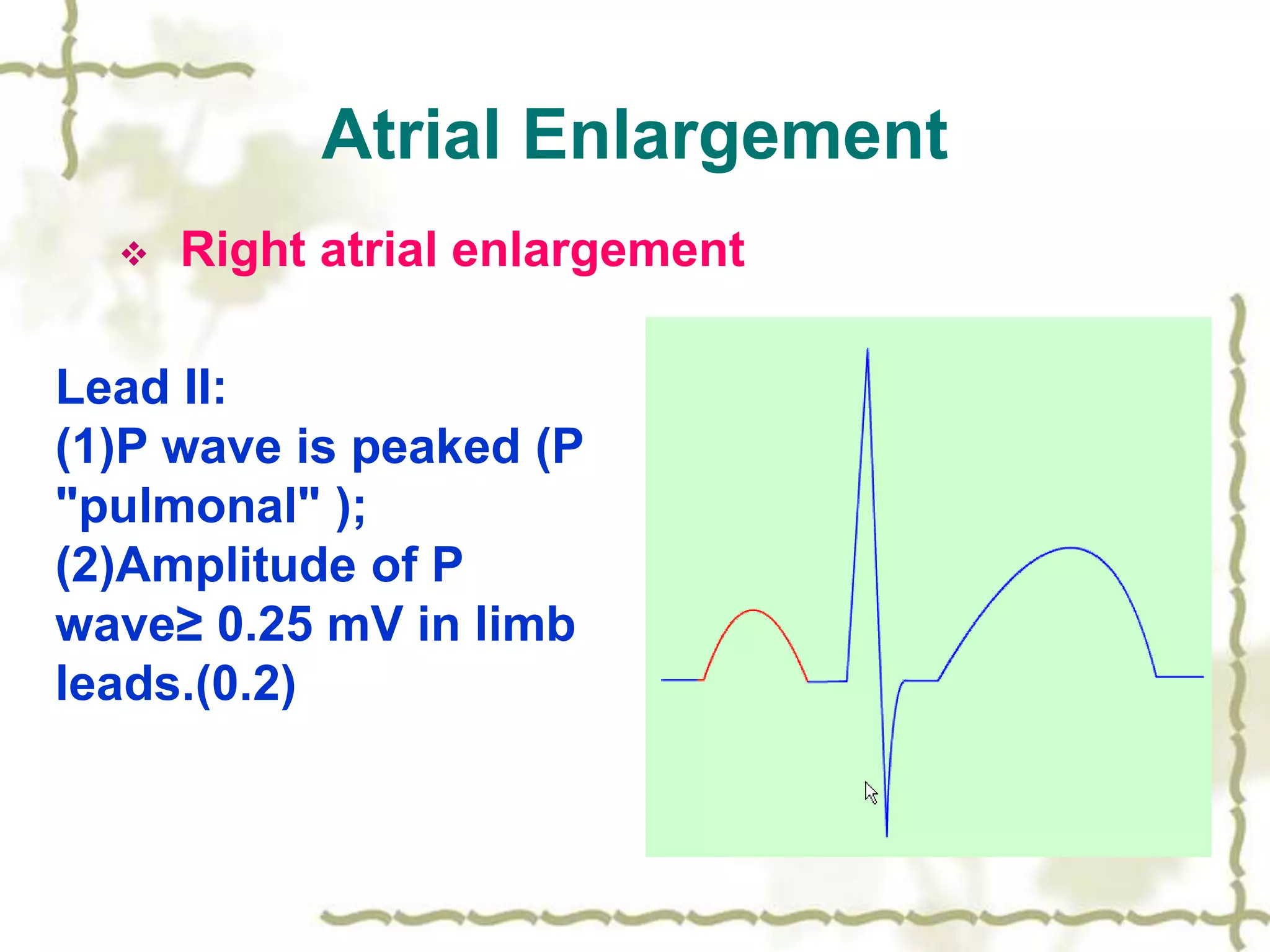 Atrial enlargement and ventricular.ppt