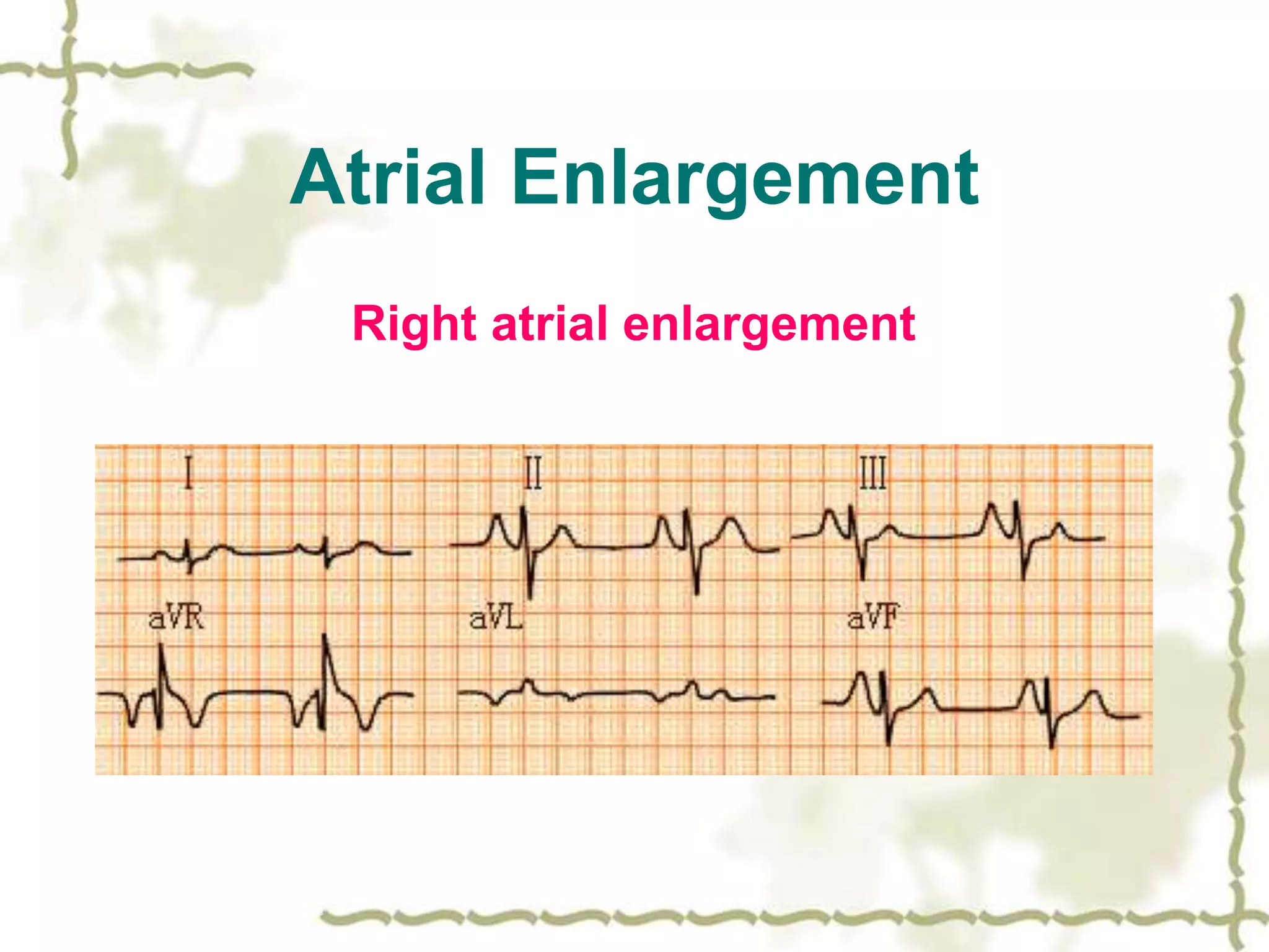 Atrial enlargement and ventricular.ppt