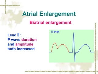 Atrial enlargement and ventricular.ppt