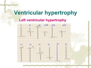 Atrial enlargement and ventricular.ppt | Heart and Cardiovascular ...
