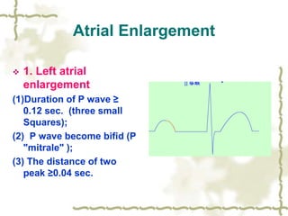 Atrial enlargement and ventricular.ppt