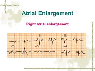 Atrial enlargement and ventricular.ppt
