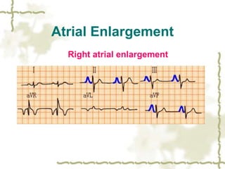 Atrial enlargement and ventricular.ppt