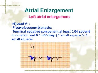 Atrial Enlargement On Ekg