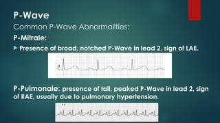Atrial Enlargement, left and right atrial enlargement and p wave ...