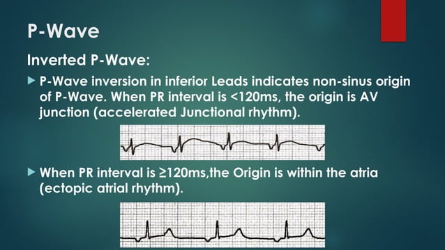 Atrial Enlargement, left and right atrial enlargement and p wave ...
