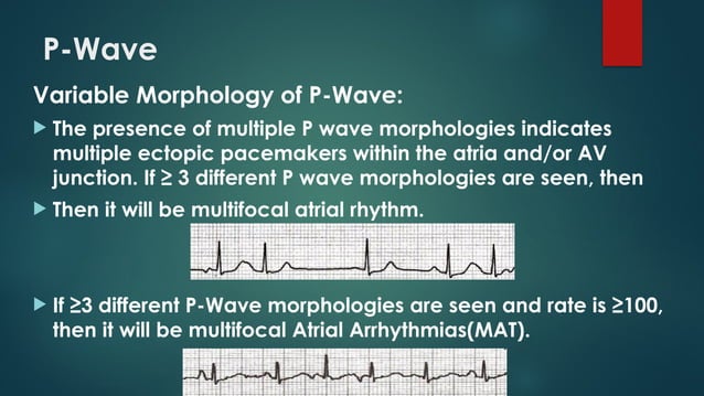 Atrial Enlargement, left and right atrial enlargement and p wave ...