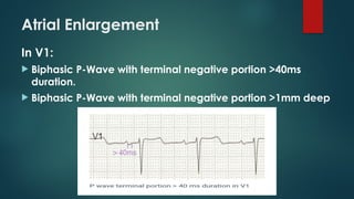 Atrial Enlargement, left and right atrial enlargement and p wave ...