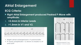 Atrial Enlargement, left and right atrial enlargement and p wave ...