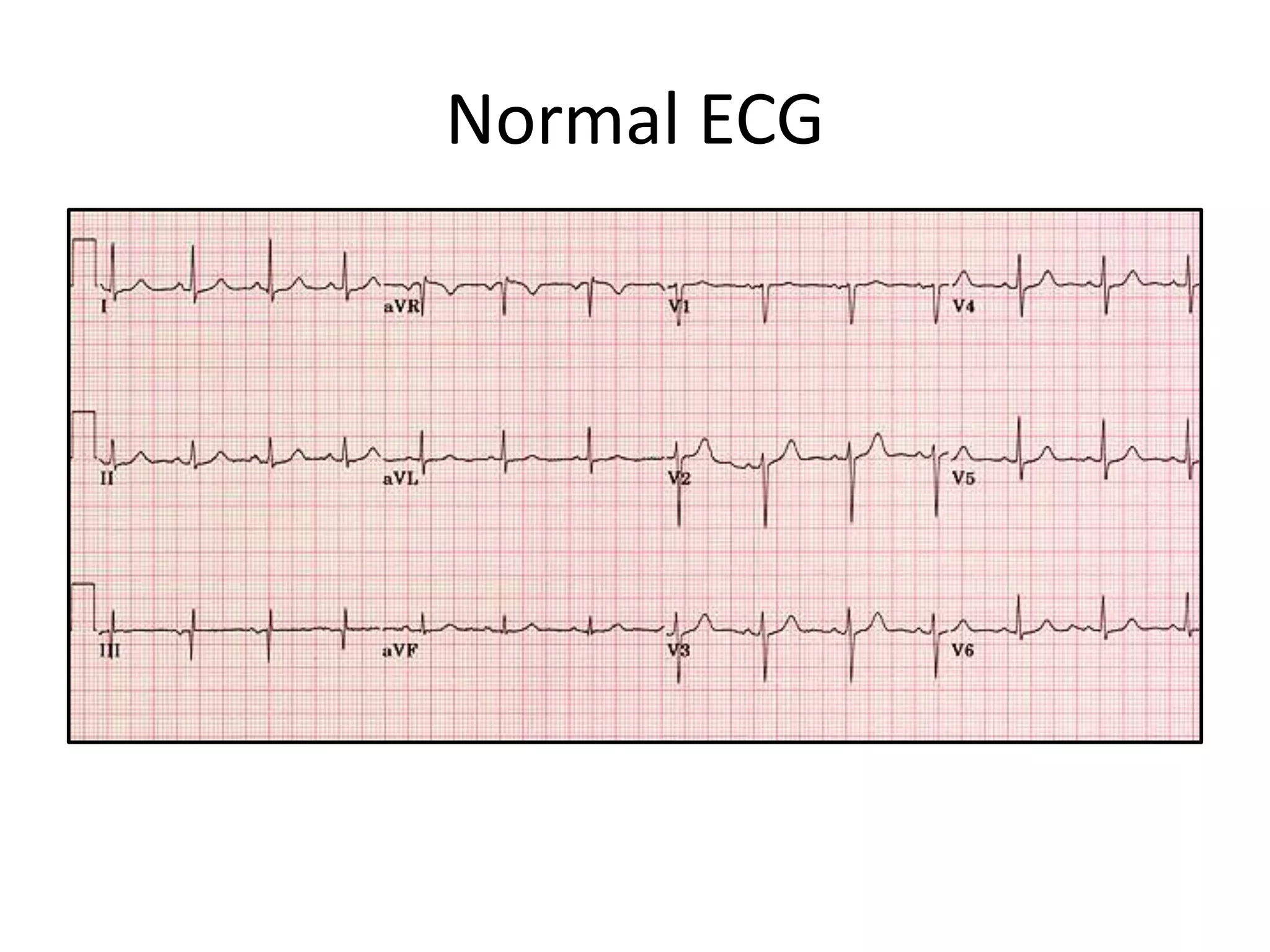 Atrial fib & flutter | PPTX