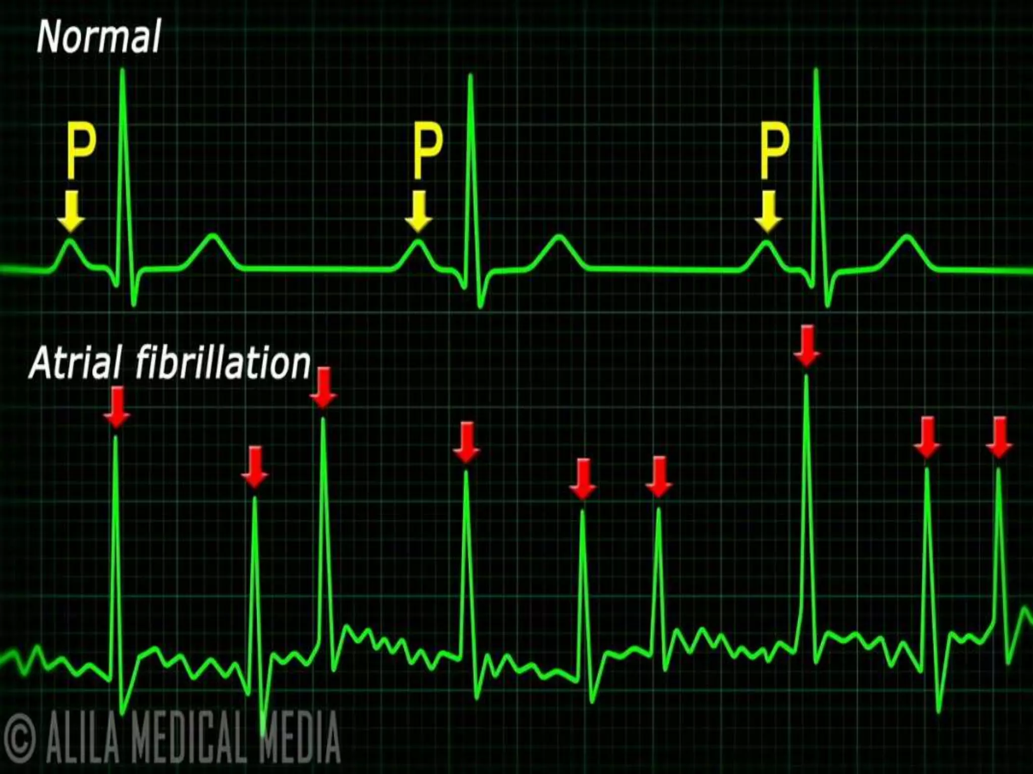 Atrial fib & flutter | PPTX