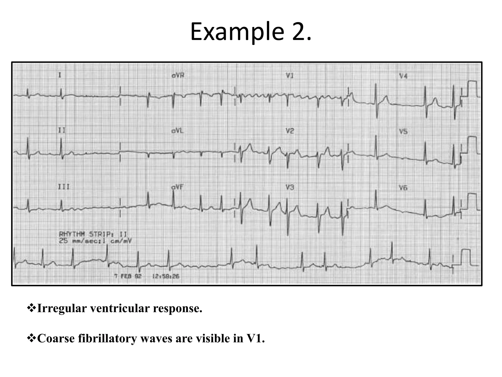 Atrial fib & flutter | PPTX