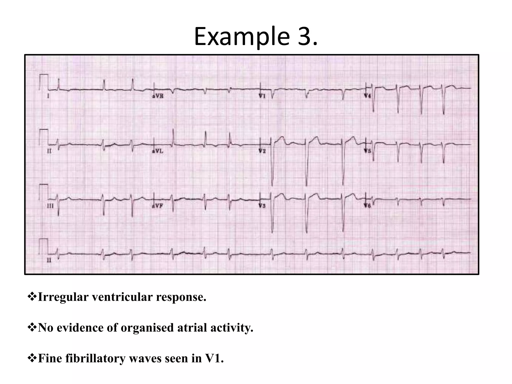 Atrial fib & flutter | PPTX