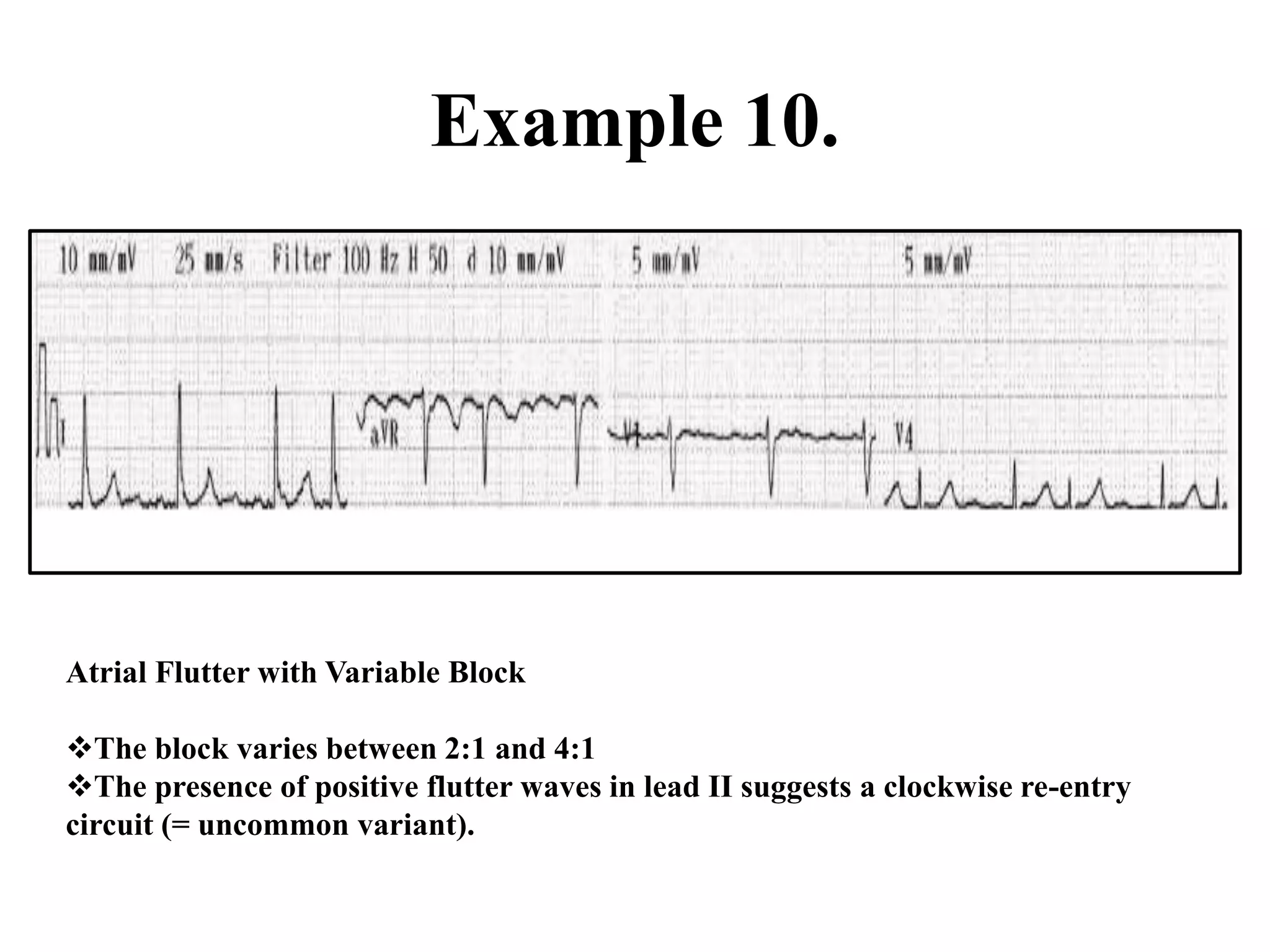 Atrial fib & flutter | PPTX