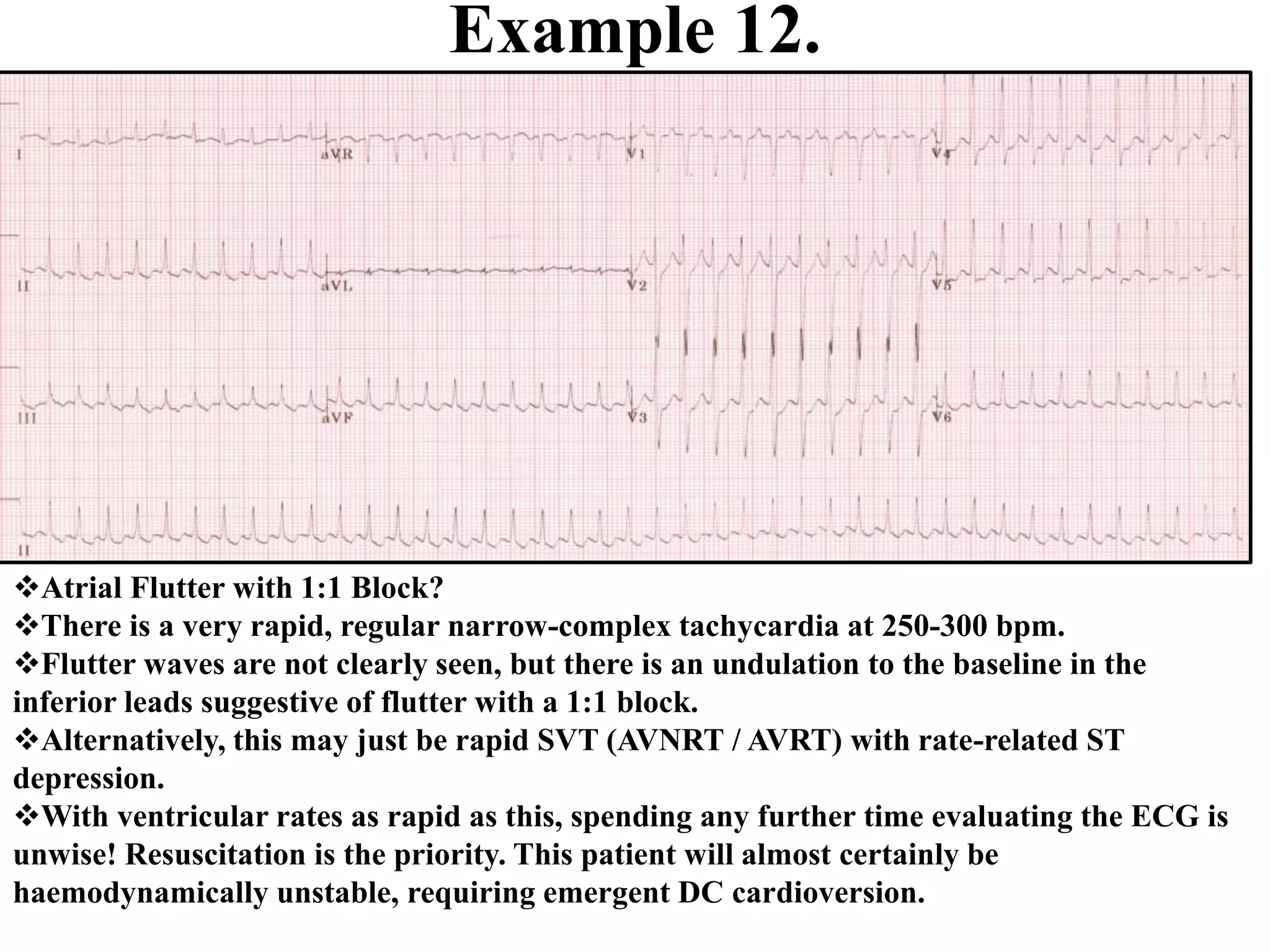 Atrial fib & flutter | PPTX