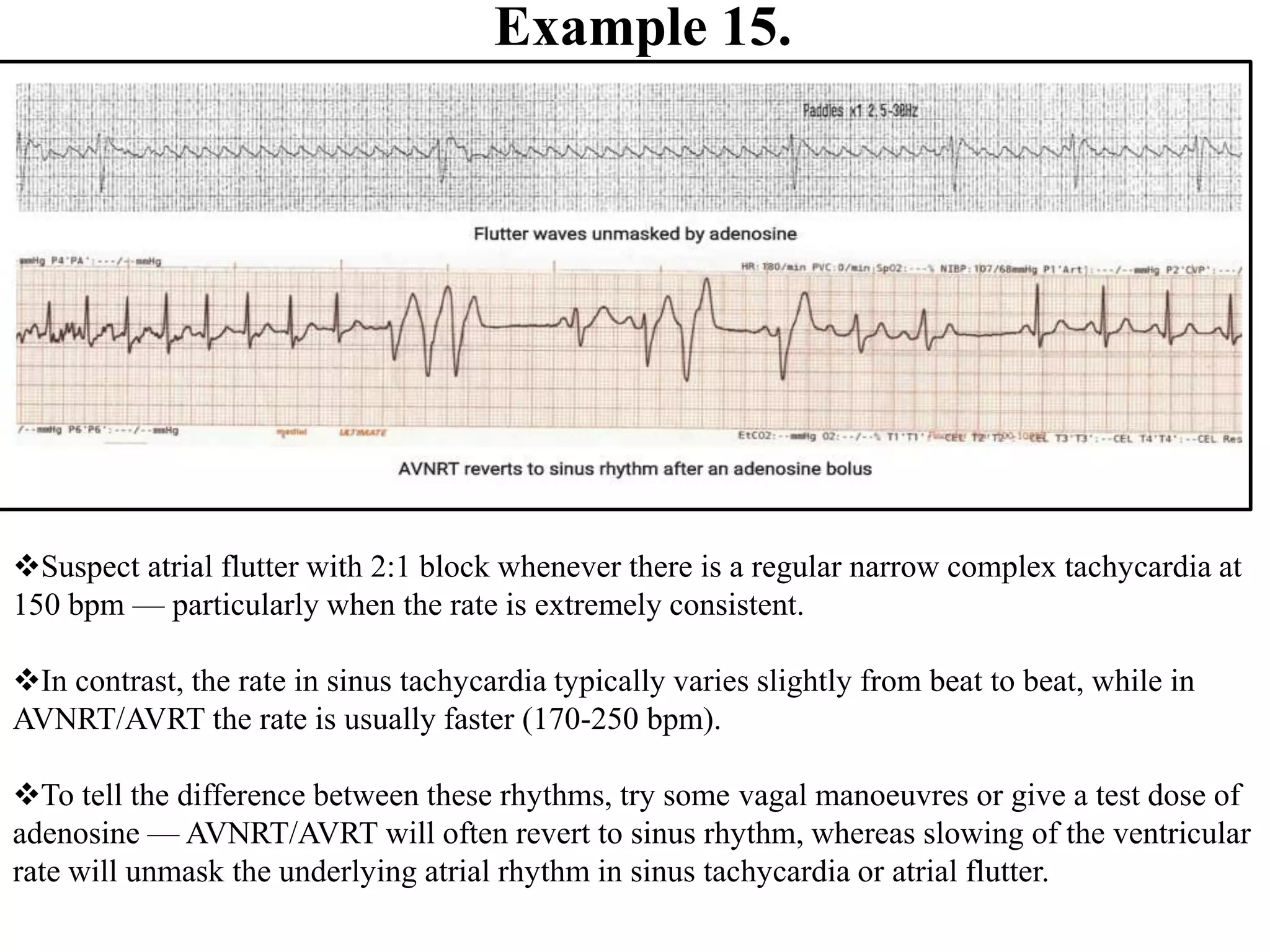 Atrial fib & flutter | PPTX