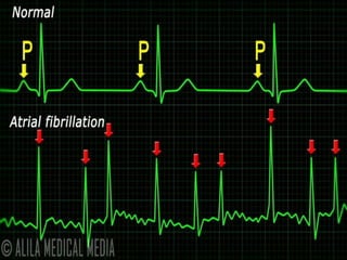 Atrial fib & flutter | PPTX