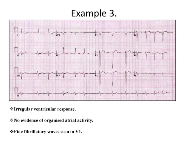 Atrial fib & flutter | PPTX | Heart and Cardiovascular Diseases ...