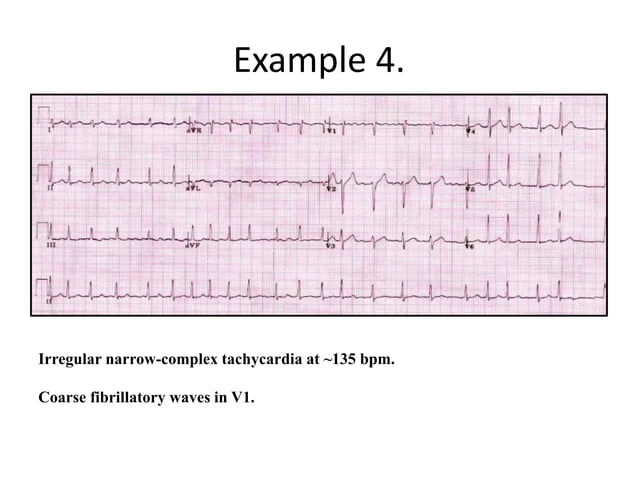 Atrial fib & flutter | PPTX | Heart and Cardiovascular Diseases ...