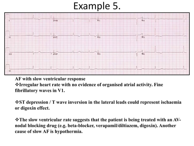 Atrial fib & flutter | PPTX | Heart and Cardiovascular Diseases ...