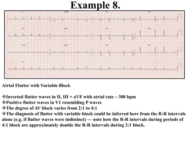 Atrial fib & flutter | PPTX | Heart and Cardiovascular Diseases ...