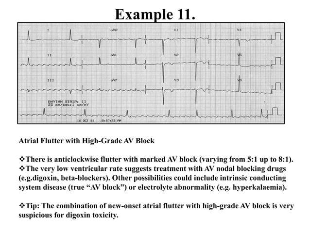 Atrial fib & flutter | PPTX | Heart and Cardiovascular Diseases ...