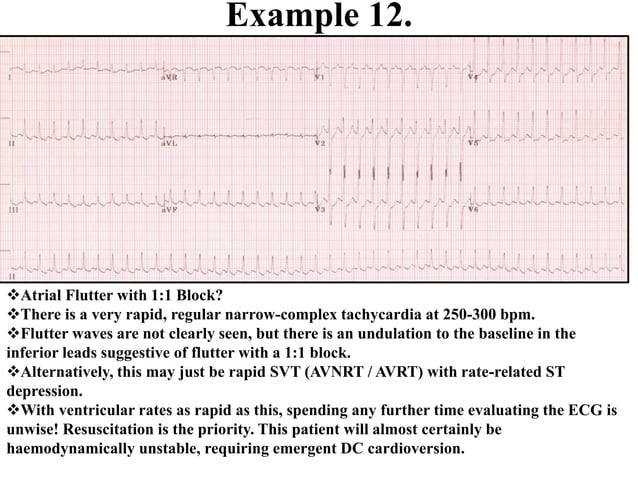 Atrial fib & flutter | PPTX | Heart and Cardiovascular Diseases ...