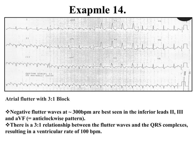 Atrial fib & flutter | PPTX | Heart and Cardiovascular Diseases ...