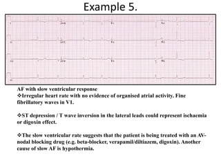 Atrial Fibrillation With Slow Ventricular Response