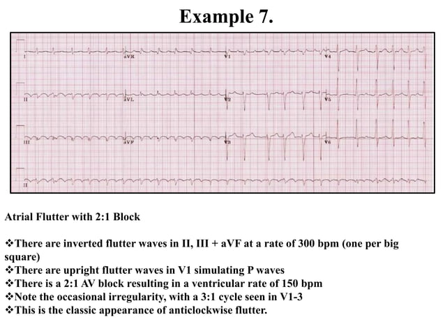 Atrial fib & flutter
