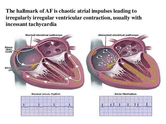 Atrial fib & flutter
