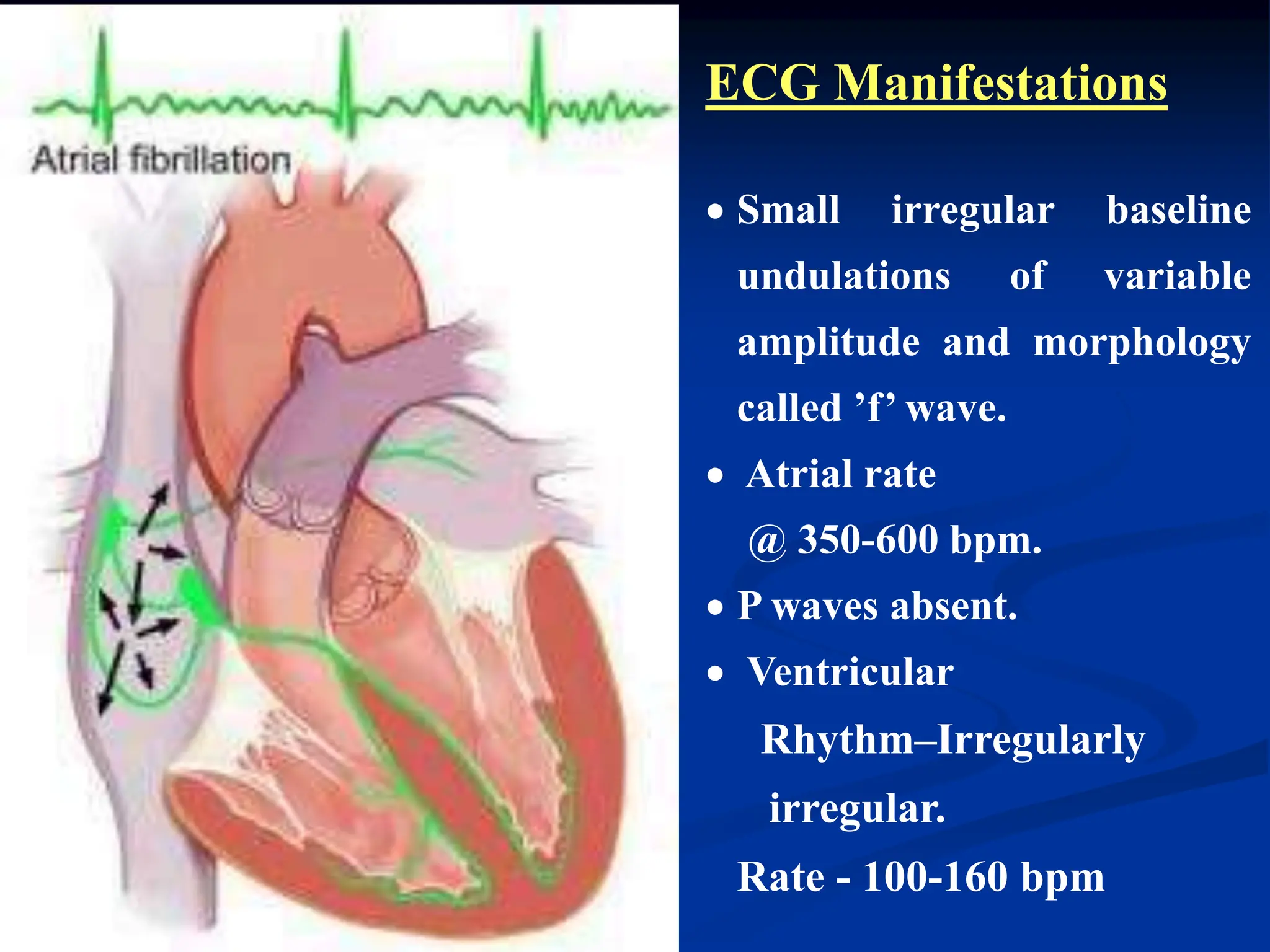 atrial fibrallition.ppt